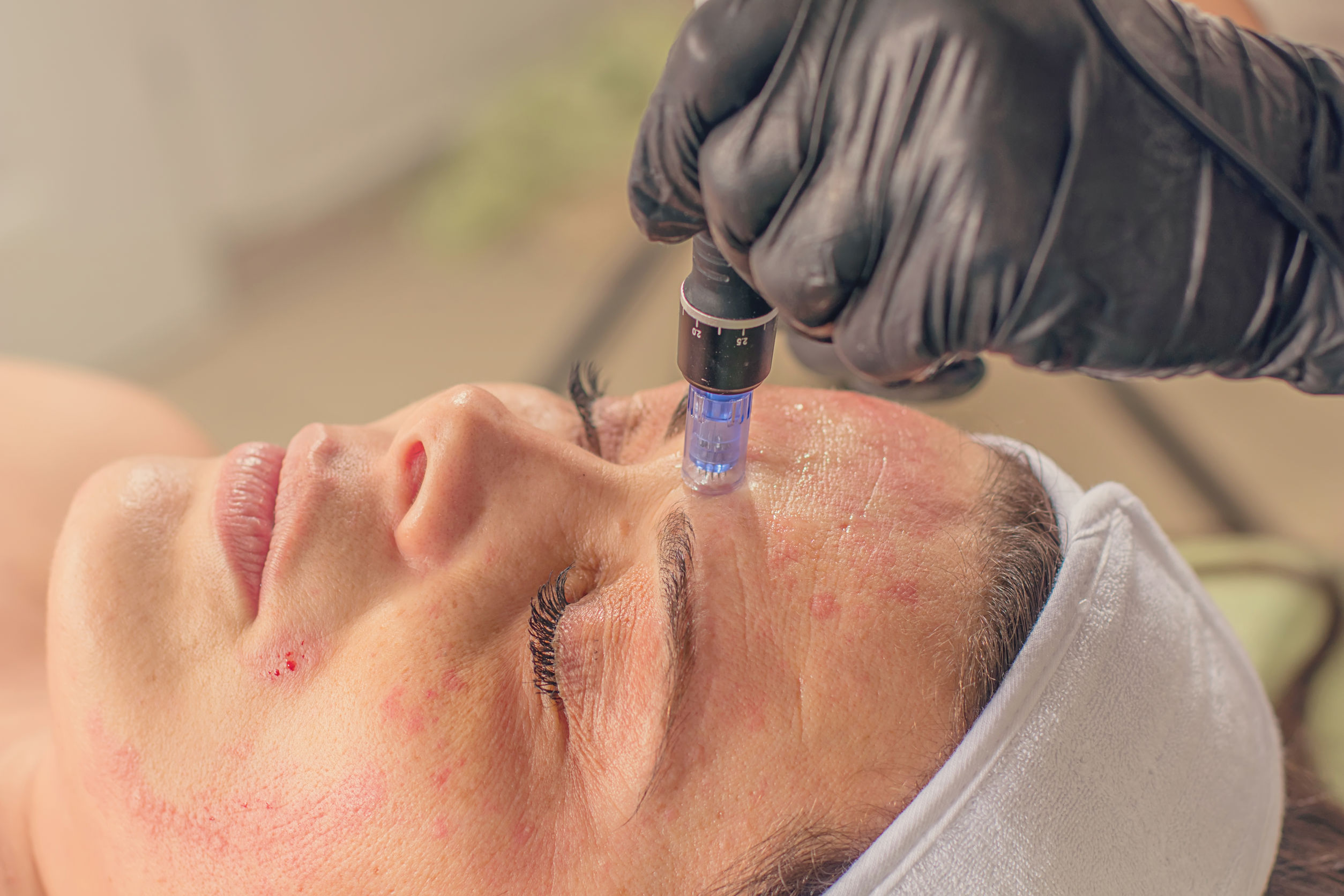 Needle mesotherapy treatment on a woman face. – Nova Dermatology